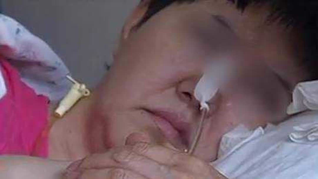 61.6公斤女商人抽脂减肥成植物人 昏迷10年后死亡 主刀医生被批捕