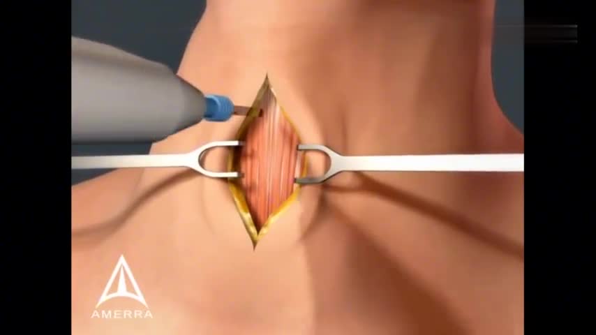 医学3D动画演示:认识气管切开术