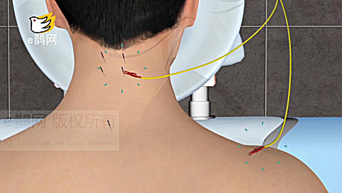 3D动画详解: 中医电针针刺法治疗颈椎病的方法和原理
