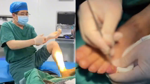 医院院长给自己开刀切肉,全程一脸淡定,一顿操作让网友傻眼