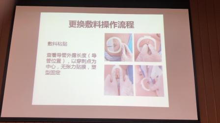 中心静脉置管知识解读