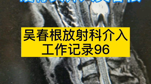 第一胸椎经皮椎体成形术、颈椎翻修术,吴春根介入示教案例96