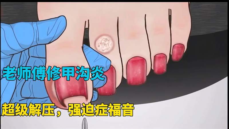 解压动画:老师傅修脚甲沟炎,过程极度解压,非常舒爽强迫症福音
