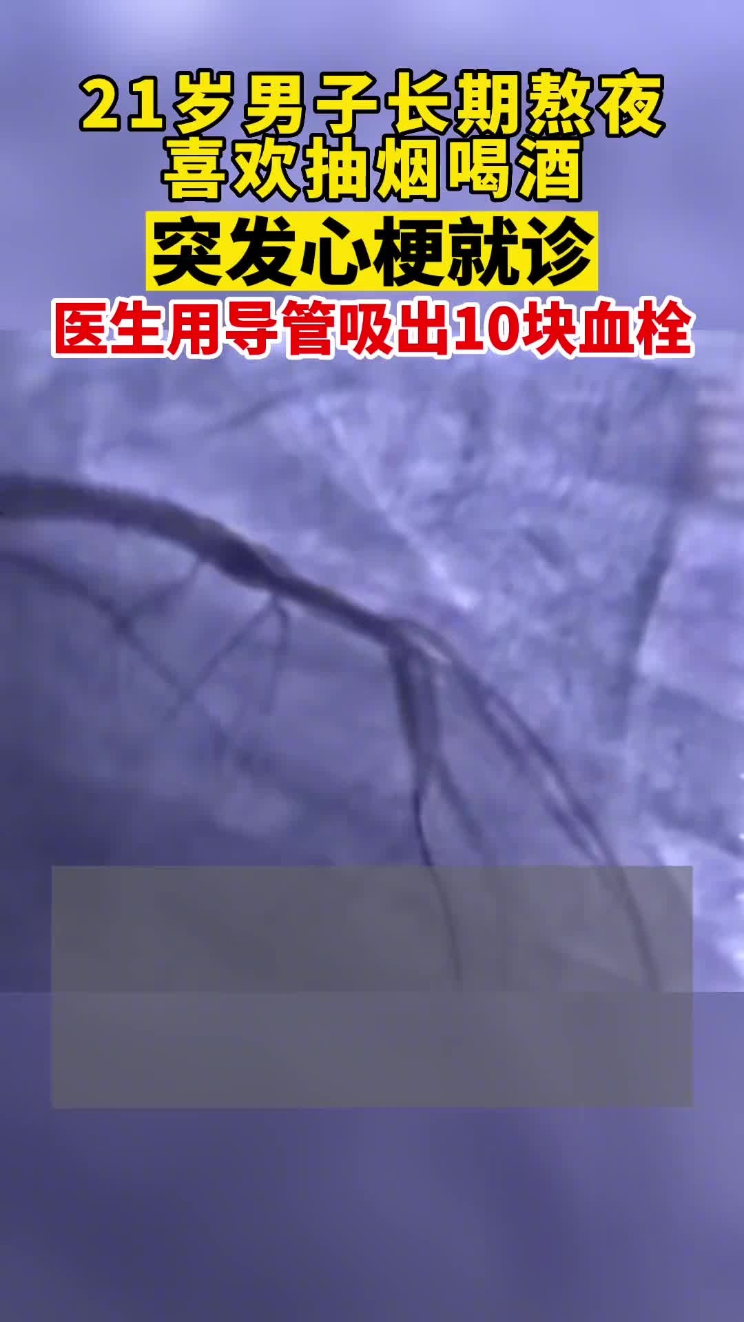 21岁男子长期熬夜、喜欢抽烟喝酒,突发心梗就诊,医生用导管吸出10块...