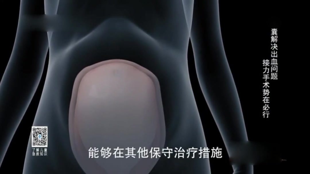 刨腹产遇子宫大出血,医生采用球囊宫腔填塞术成功止血,保住子宫