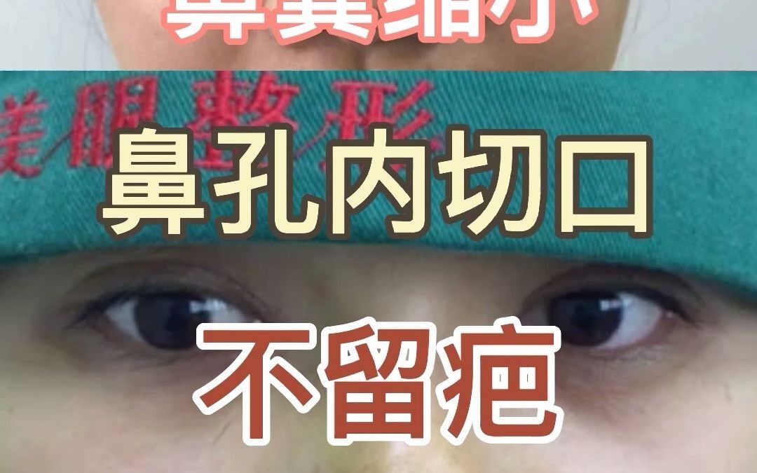 鼻翼缩小怎样才能不留疤?