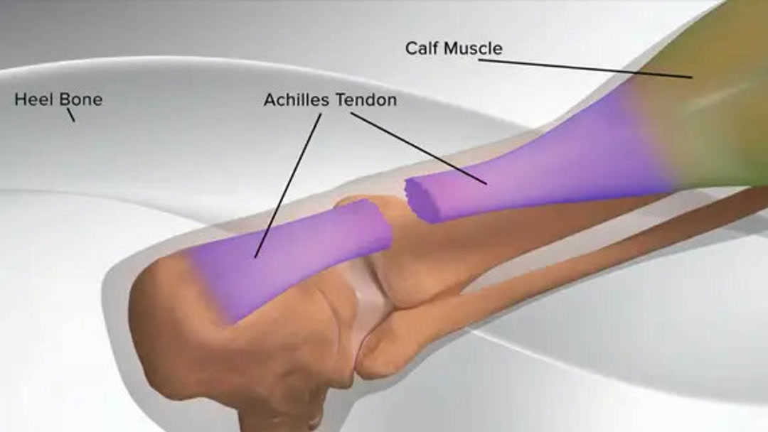 医学3D动画演示:跟腱断裂修复手术过程