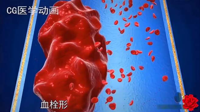 下肢静脉血栓的形成