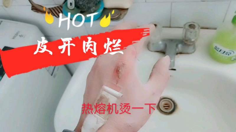 打工小伙用热容器焊ppr管道把手烫的皮开肉烂,看看一天能挣多少钱