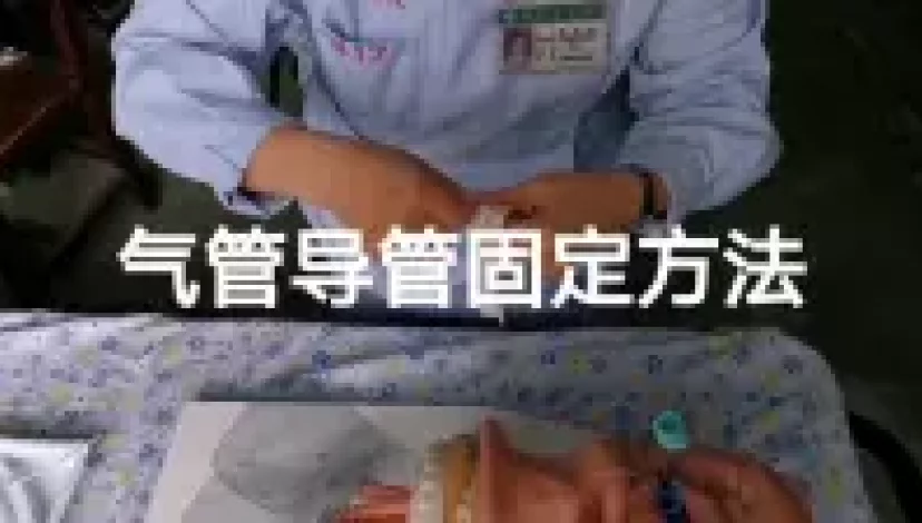 气管插管固定