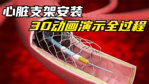 心脏支架是怎样工作的?植入内部将血管撑开,真是涨常识了!