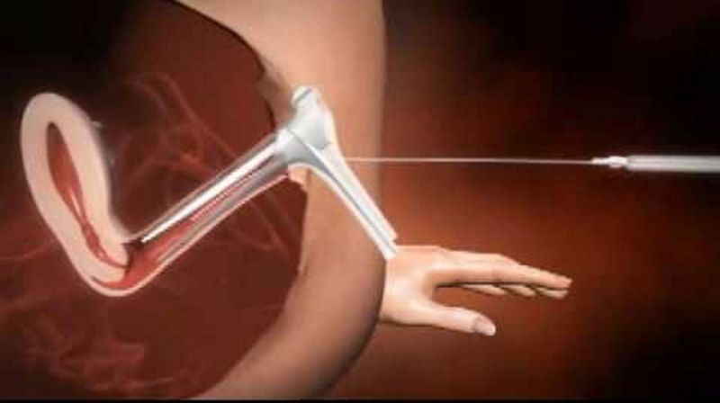 揭秘试管婴儿全过程,当妈妈太遭罪,看完后心疼妈妈一万遍