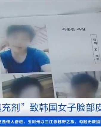 ...但受巨大利益的驱使,韩国整容医疗事故也频频发生。此前我们曾报道...