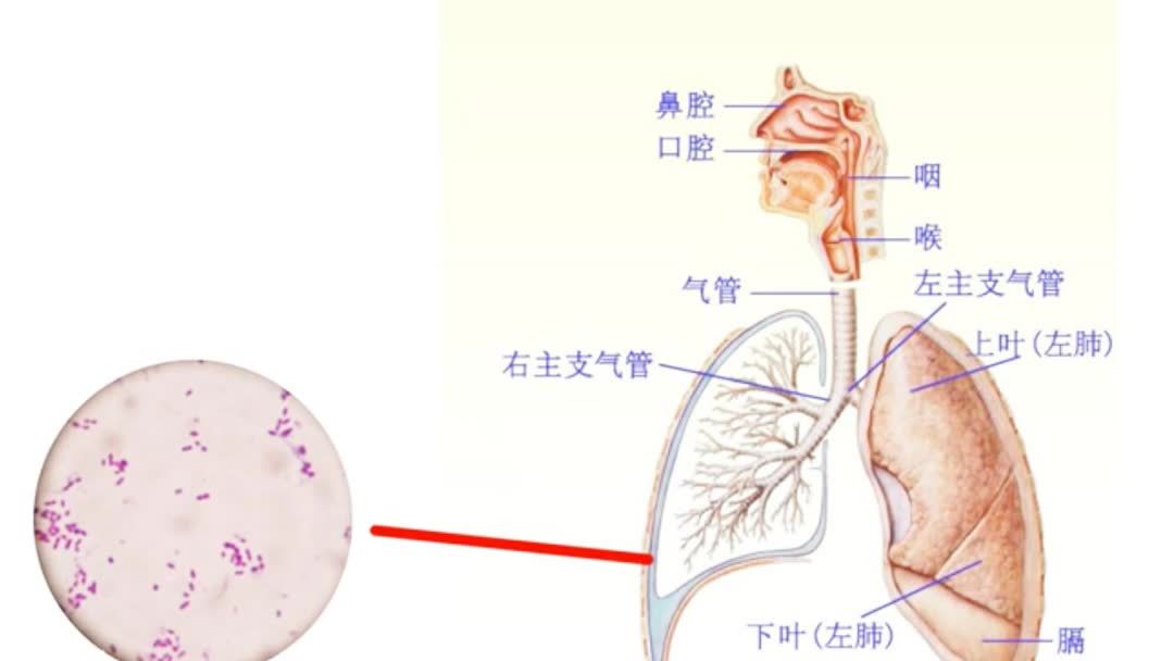 专家提醒肺结核患者咳痰时 吃这种药反而会加重病情 你还在做吗