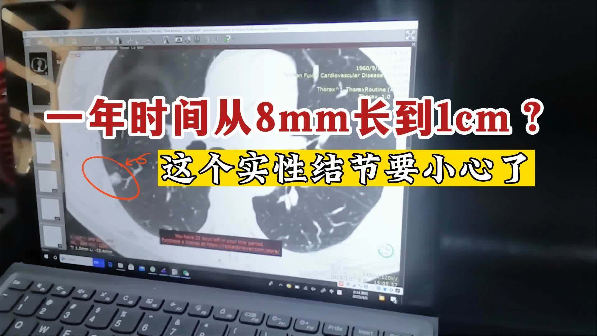 1年时间,这个实性结节从8mm长到1cm?建议做全身排查