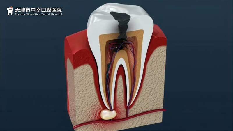 你了解根管治疗吗?