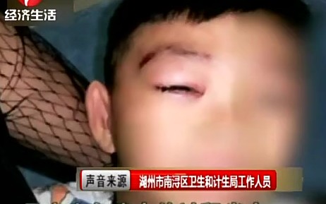 浙江:狂犬病!男孩被狗咬13天去世