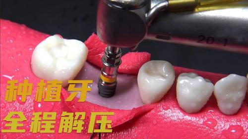 看着都疼的种植牙过程,而最痛的在最终,全程解压