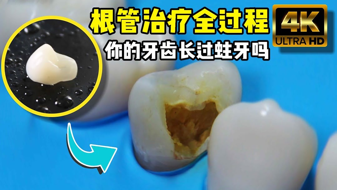 一颗坏透的牙齿,能让你痛不欲生,根管治疗全过程,既酸爽又解压