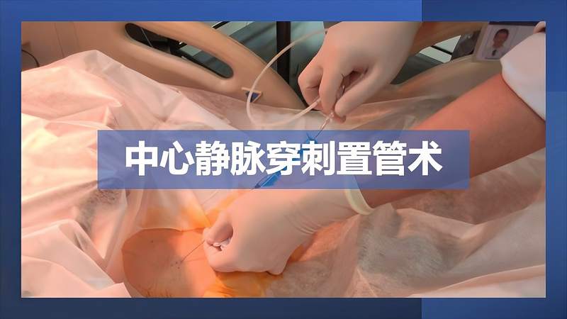 中心静脉穿刺置管术