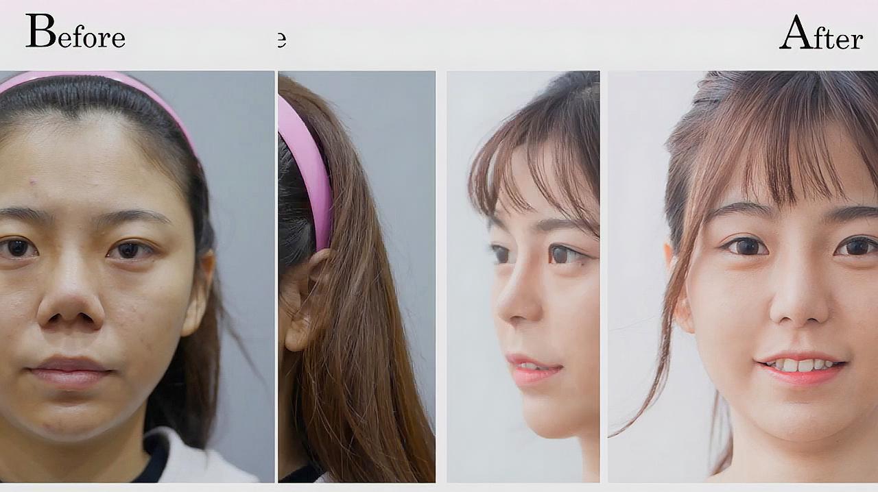 美女隆鼻手术鼻整形心得日记分享,全过程记录,网友真的逆袭了!