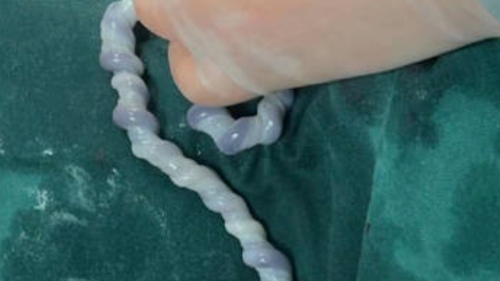 胎儿50厘米脐带扭转54圈成“麻花”,医生:这孩子太调皮了