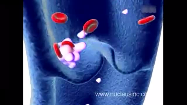 30秒看懂深静脉血栓是如何导致肺栓塞的