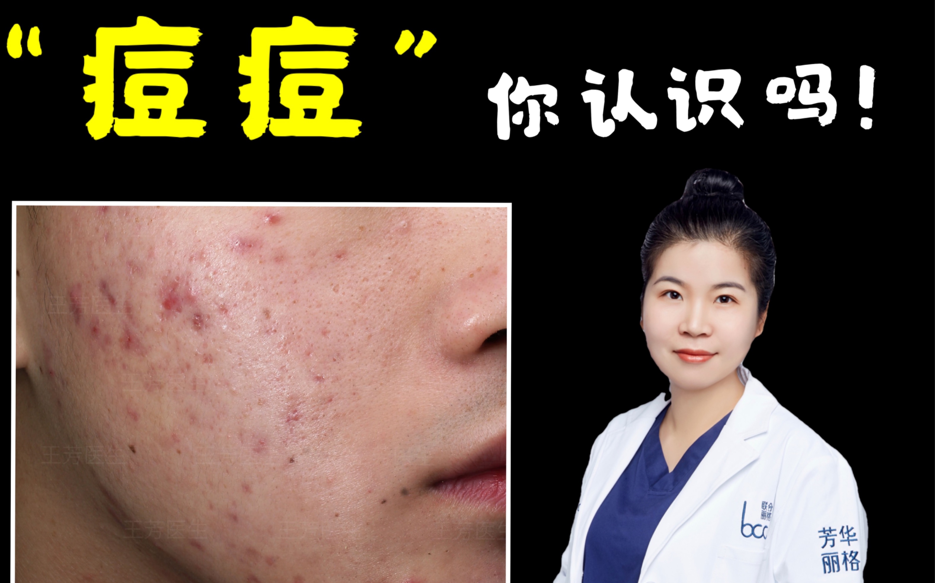 皮肤科医生分享: 教你正确认识面部痘痘