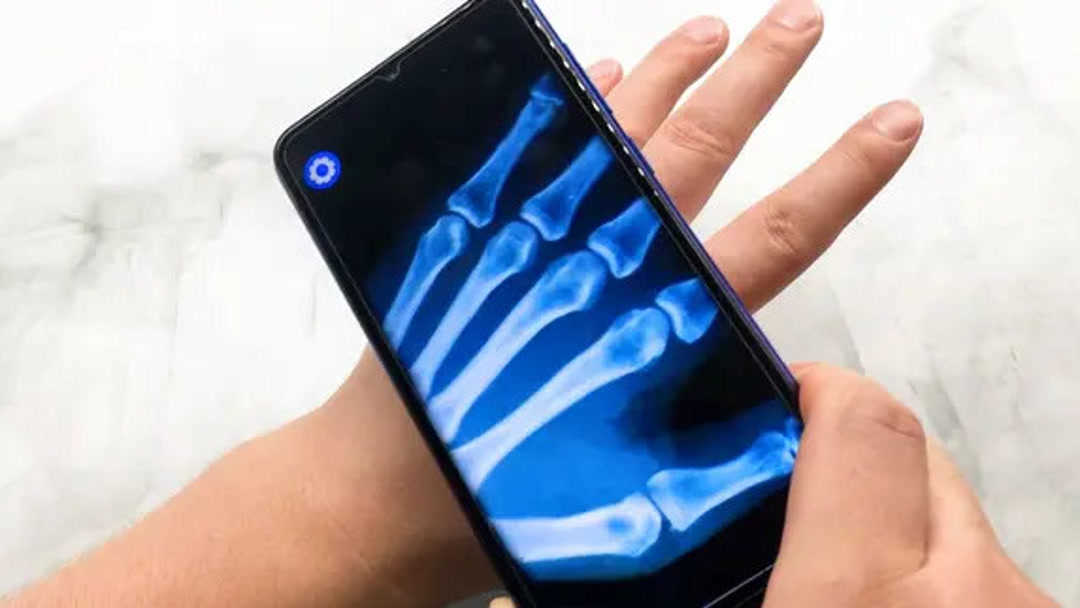 教你把手机变成X光CT扫描仪,手掌骨骼能看得很清楚,赶快学会