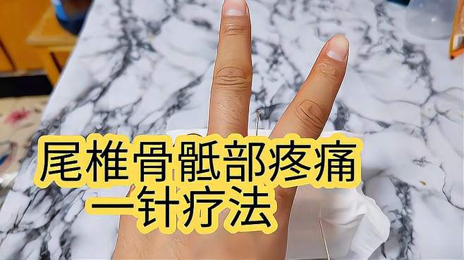 尾椎骨骶部疼痛一针疗法