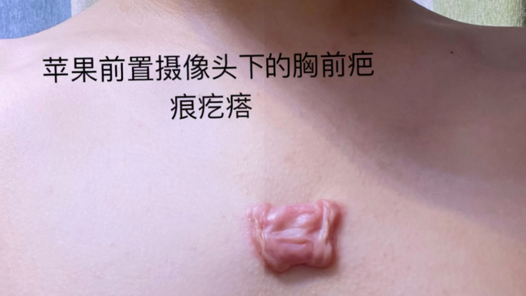 疤痕疙瘩第一个疗程,希望越来越多的人可以知道这个治疗方法