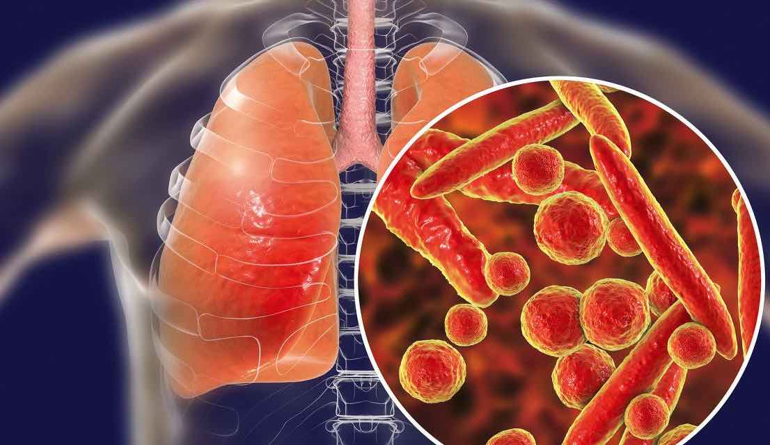 美国华裔专家:不排除新型冠状病毒肺炎病人的尿液和粪便具有传染性