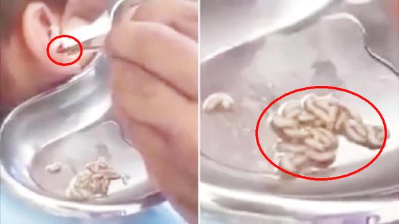 家长看丨男童耳朵奇痒,医生掏数十条活蛆虫,只因平时不注意卫生