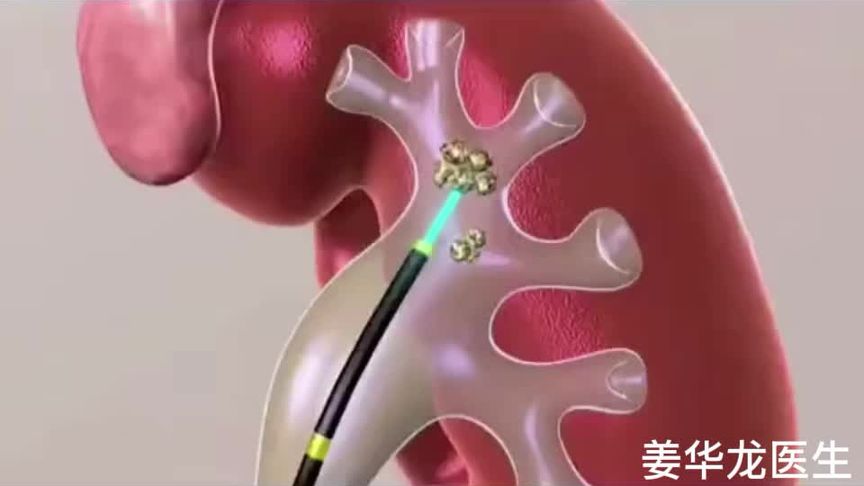 输尿管软镜碎石#输尿管软镜 #微创碎石#自然腔道
