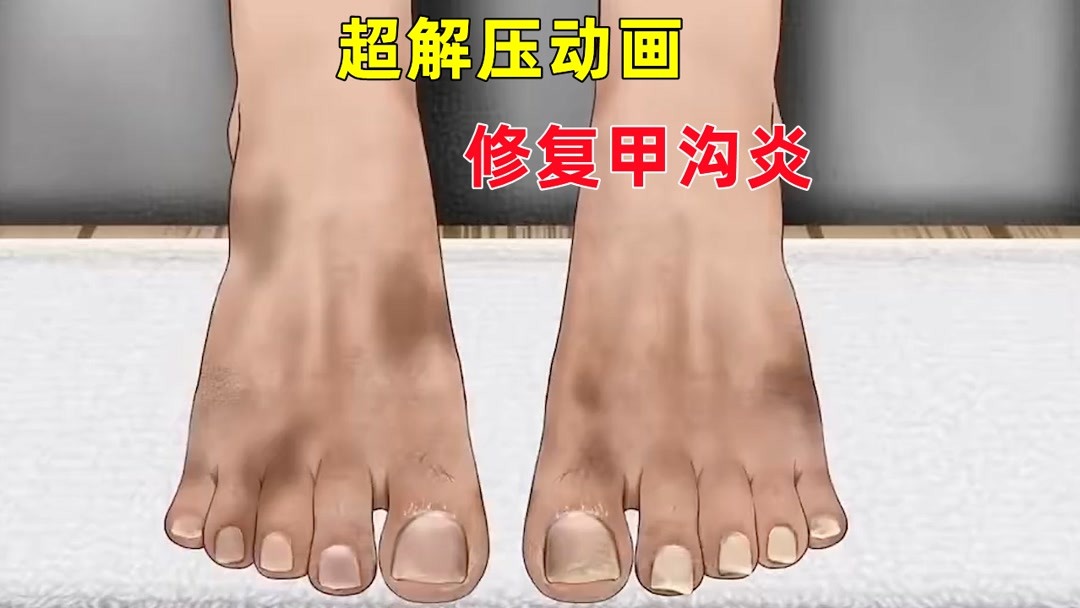 第1视角带你舒适解压,沉静式体验修脚甲沟炎动画,过程太下饭了