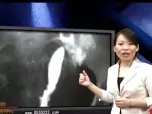 输卵管造影片子怎么看