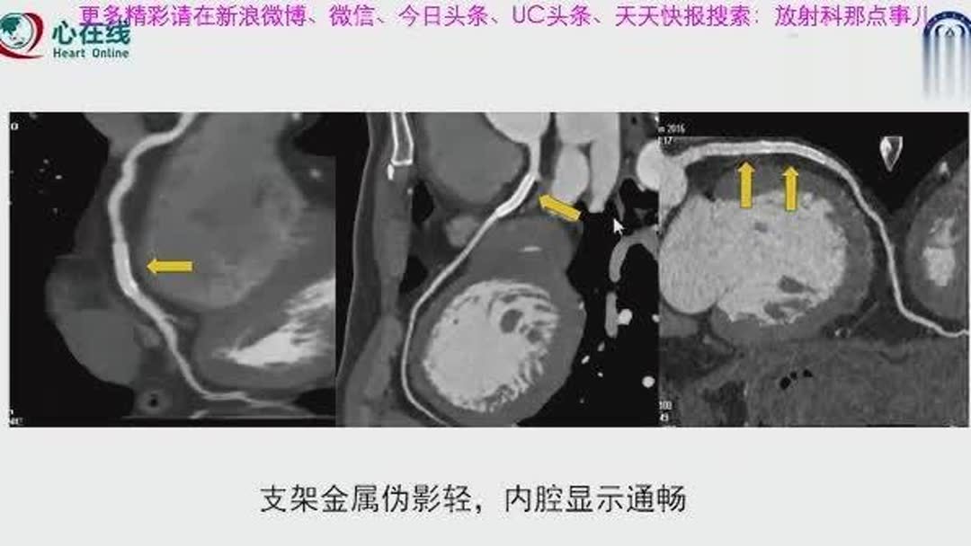 听影像大咖讲:冠状动脉支架的CTA评价(安贞医院-徐磊)
