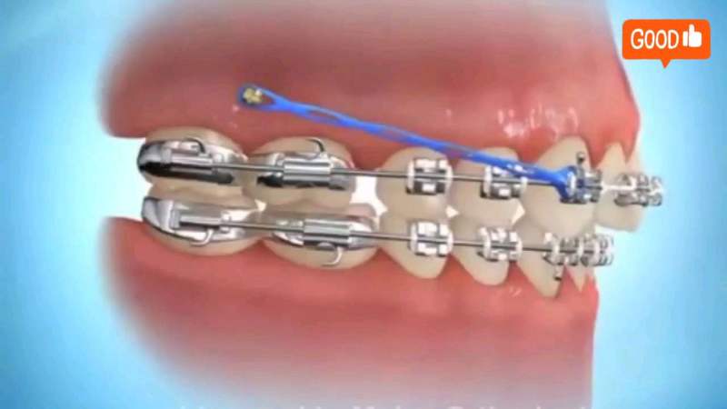 牙齿矫正牙齿正畸过程