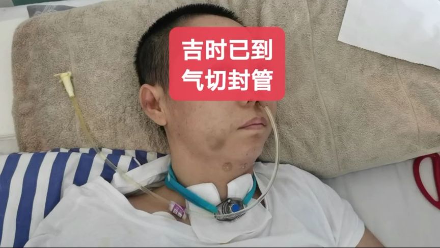 马上开始气切封管了