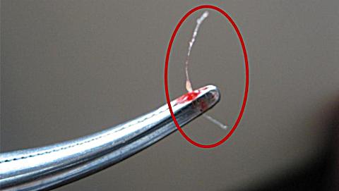 鱼刺卡喉真要命, 3个不为人知的小方法, 你知道了等于在自救!