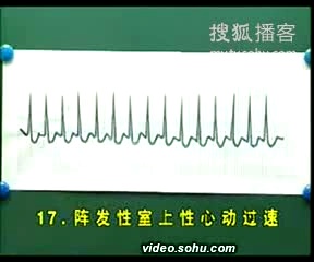 怎样看心电图在线观看-心电图讲座