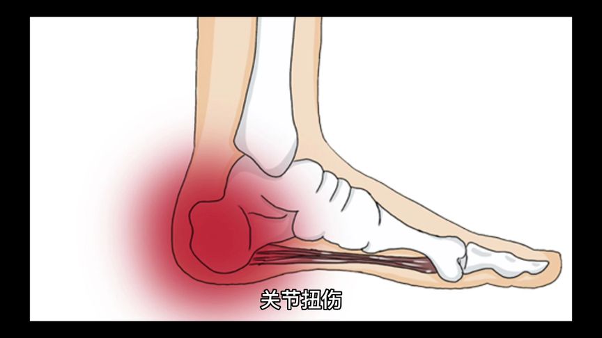 运动损伤——扭伤处理方法