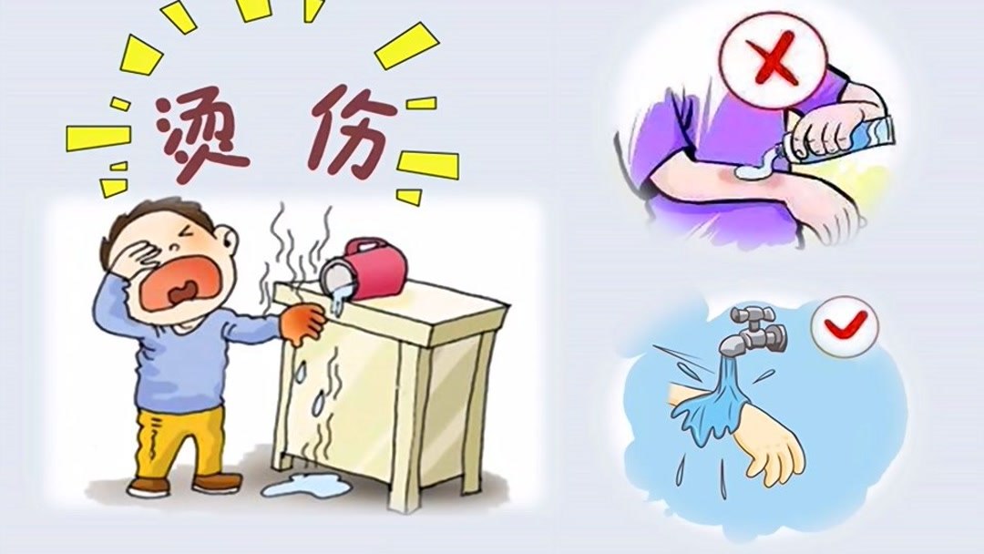 烫伤如何正确处理?医生针对三个级别的烫伤给出专业建议。