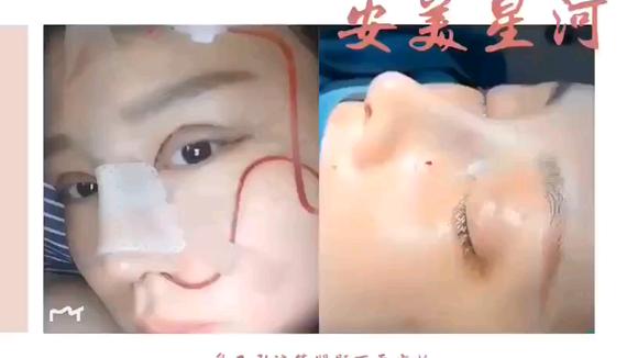 科普:为什么有些人隆鼻后要戴引流管?