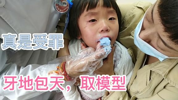 四岁儿童牙齿地包天,要做矫正,取模型取了两次,可怜啊