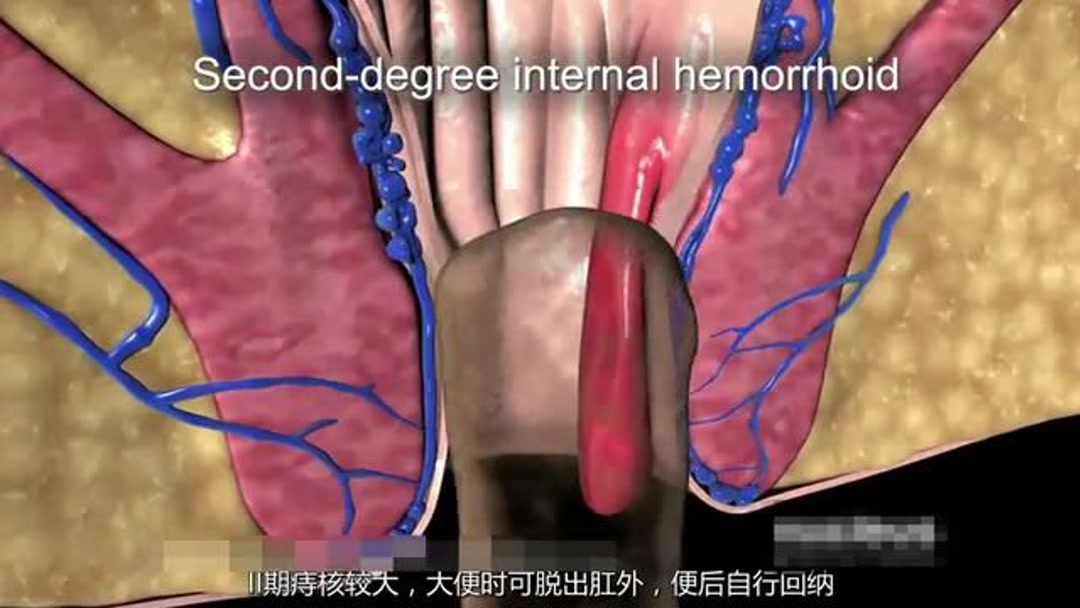 3D演示痔疮的形成和治疗
