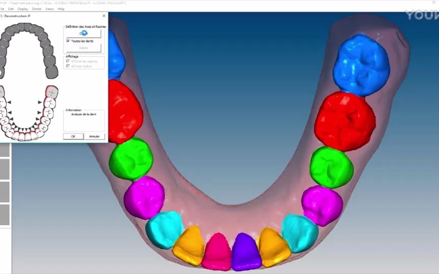 正畸软件分享 | ORTH'UP - 正畸模型预备+分牙