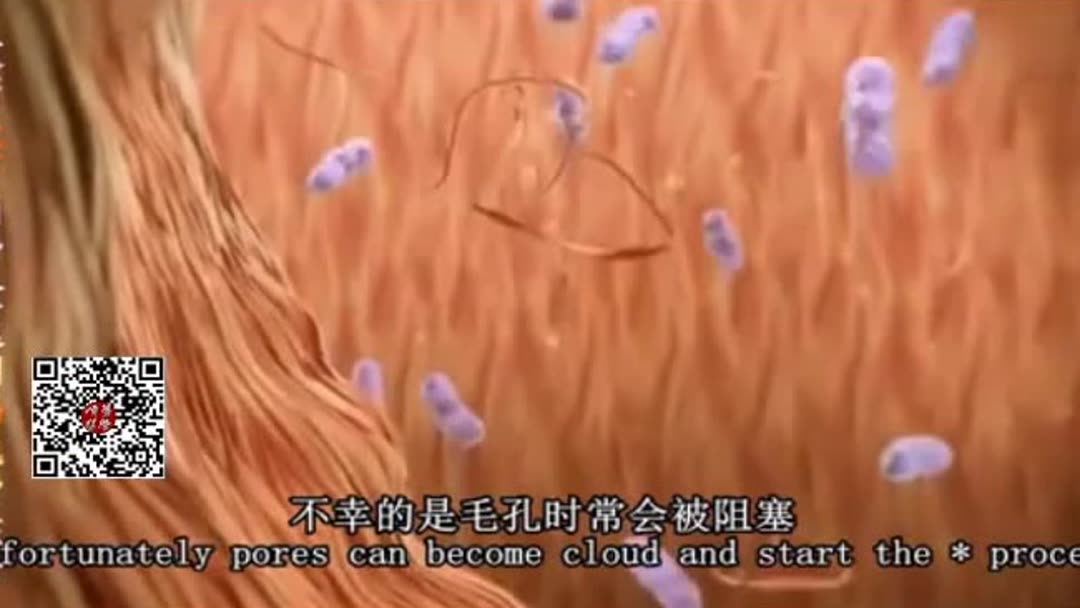 医学动画 粉刺是如何形成的