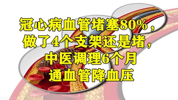 血管堵塞80%做了4个支架还是堵,中医调理6个月通血管降血压