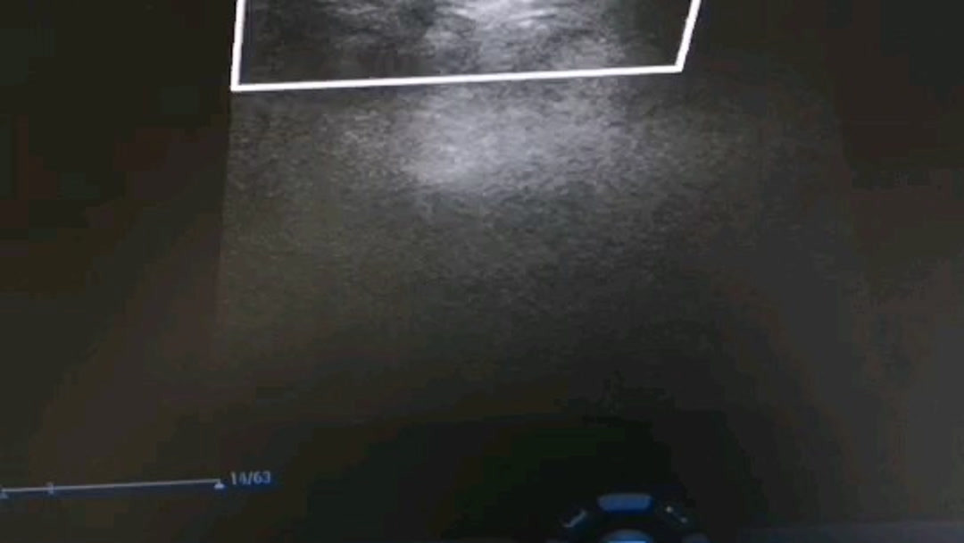 血栓闭塞性脉管炎?